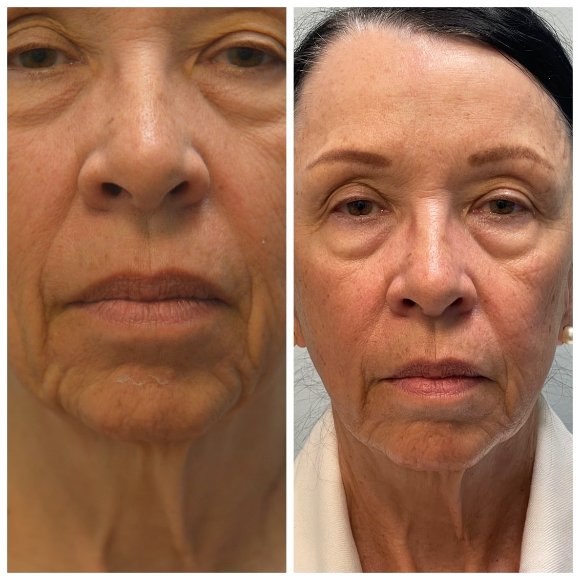 Aptos™ and Silhouette™ Thread Lift - Live Younger