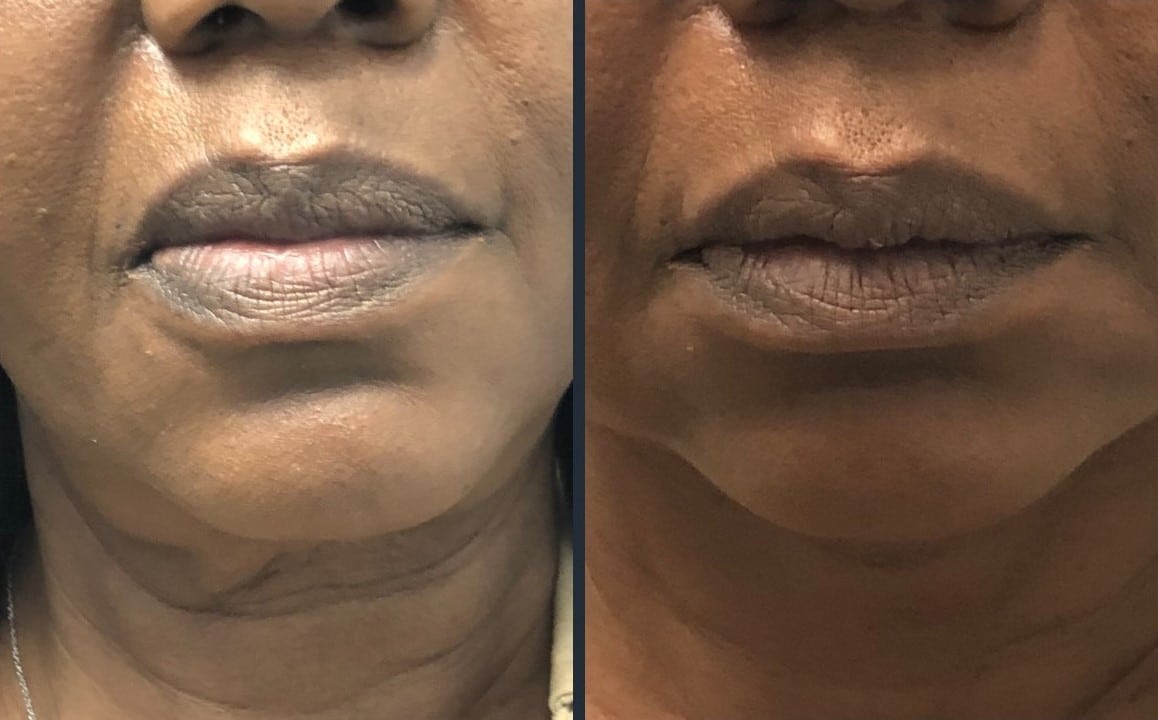 Aptos™ and Silhouette™ Thread Lift - Live Younger