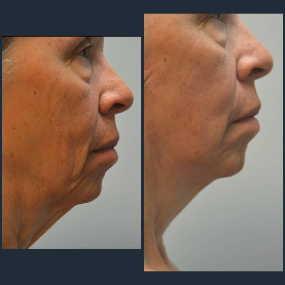 Aptos™ and Silhouette™ Thread Lift - Live Younger